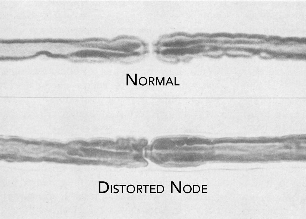 normal-distorted-node | Fascial Distortion Model®